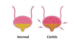 Cistitis con Ayurveda - Escuela de Ayurveda de CA